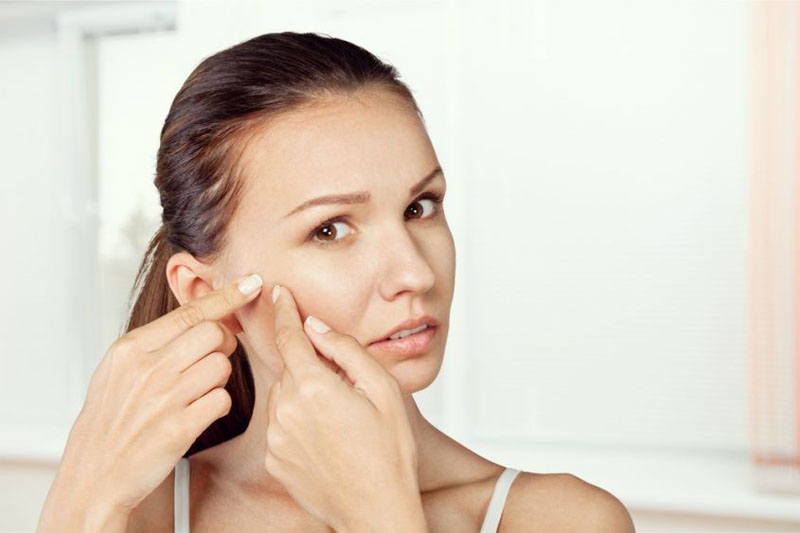 La Capital | Acne En Adultos Afecta Mas A Mujeres Por Factores ...
