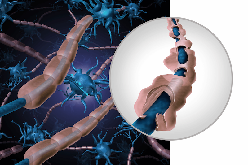 La Capital | Proponen Terapia Para Ninos Con Esclerosis Multiple