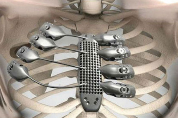 La Capital | Implantan Caja Toracica Y Esternon Elaborados En Impresora 3D